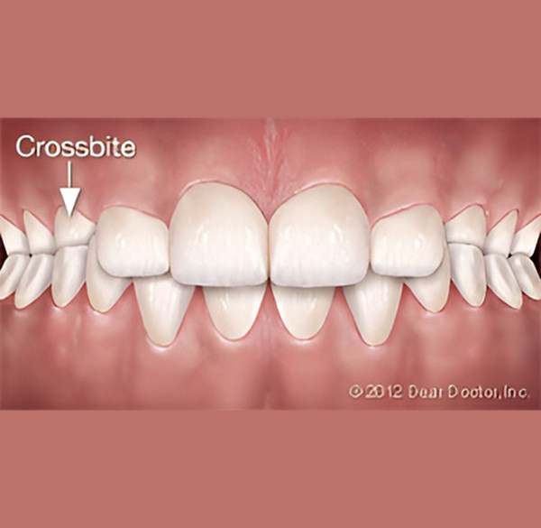 Guide to Palatal Expanders for Kids | Mack Orthodontics