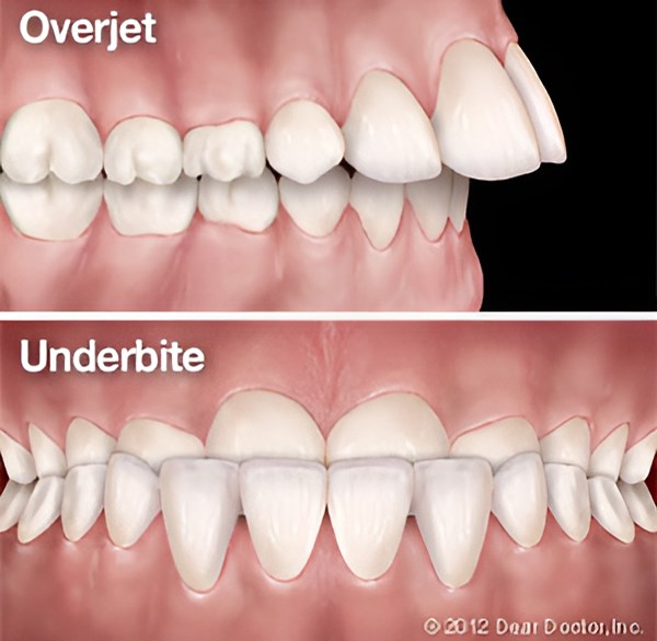 Orthodontic Headgear: How It Works | Mack Orthodontics
